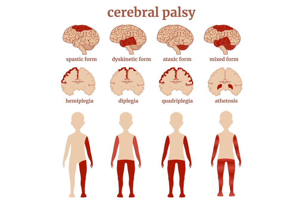 4 Types of Cerebral Palsy - Learn About Each Type