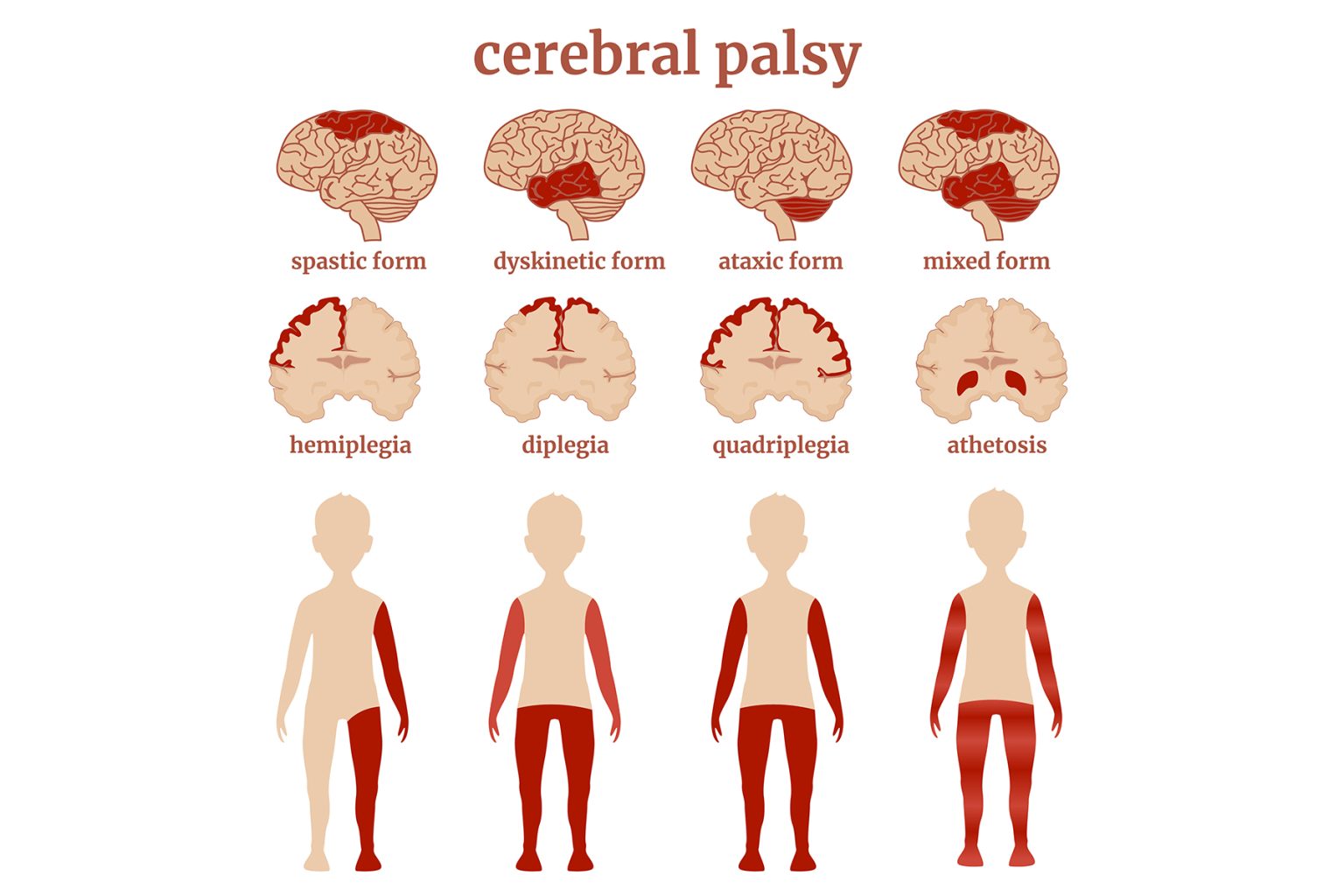 4 Types of Cerebral Palsy - Learn About Each Type